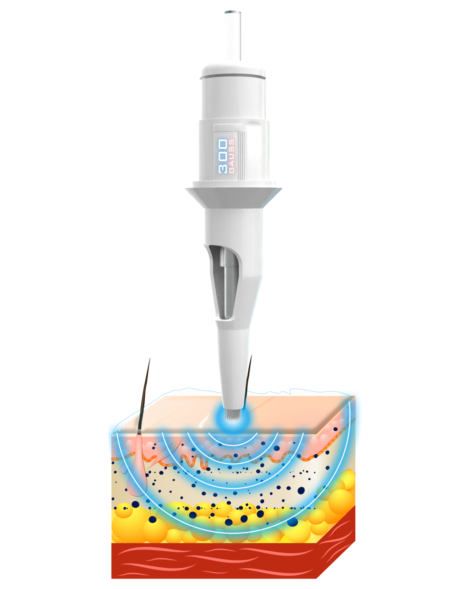 Non Laser Magnetic Tattoo Removal - Select Beauty Solutions